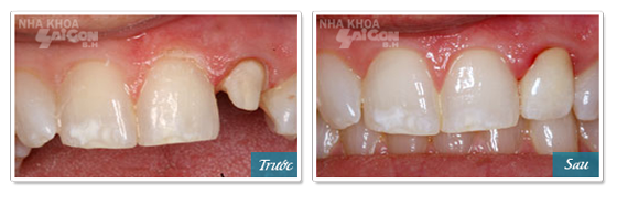 Bọc răng sứ phục hình răng thẩm mỹ cố định